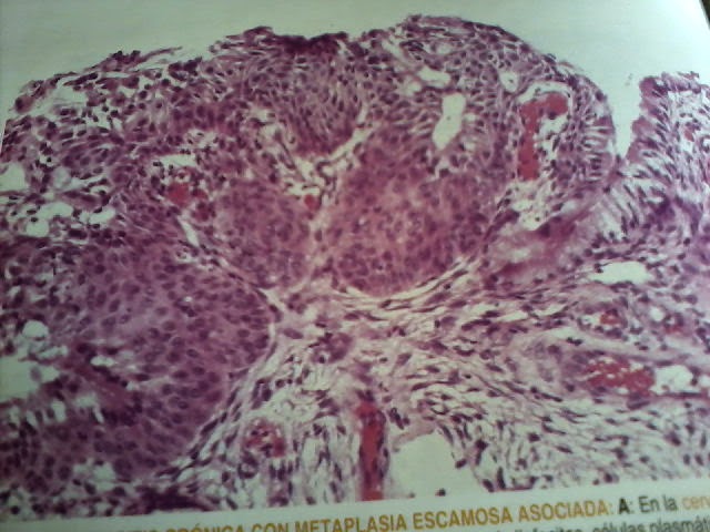 Agustina Ocampo - Patología B 2014: Cervicitis aguda y crónica